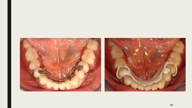 PEEK :Polyetheretherketone applications in clinical dentistry | PPTX