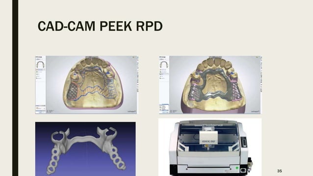 PEEK :Polyetheretherketone applications in clinical dentistry | PPTX