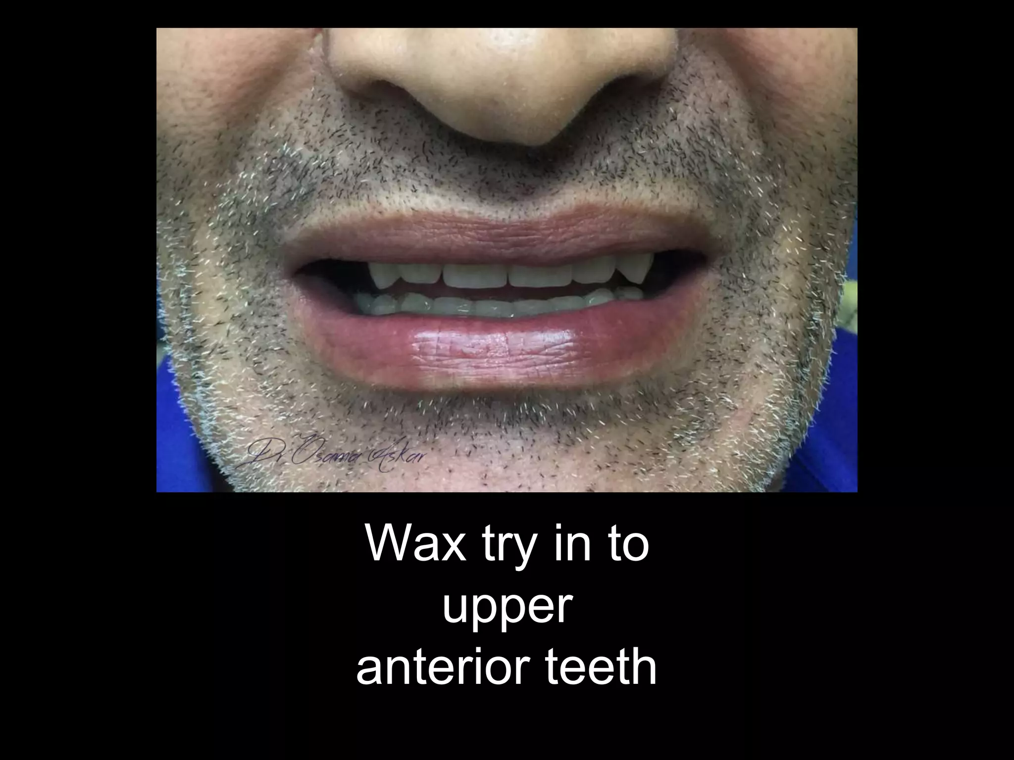 Peek implant supported screw retained maxillary complete overdenture | PPTX
