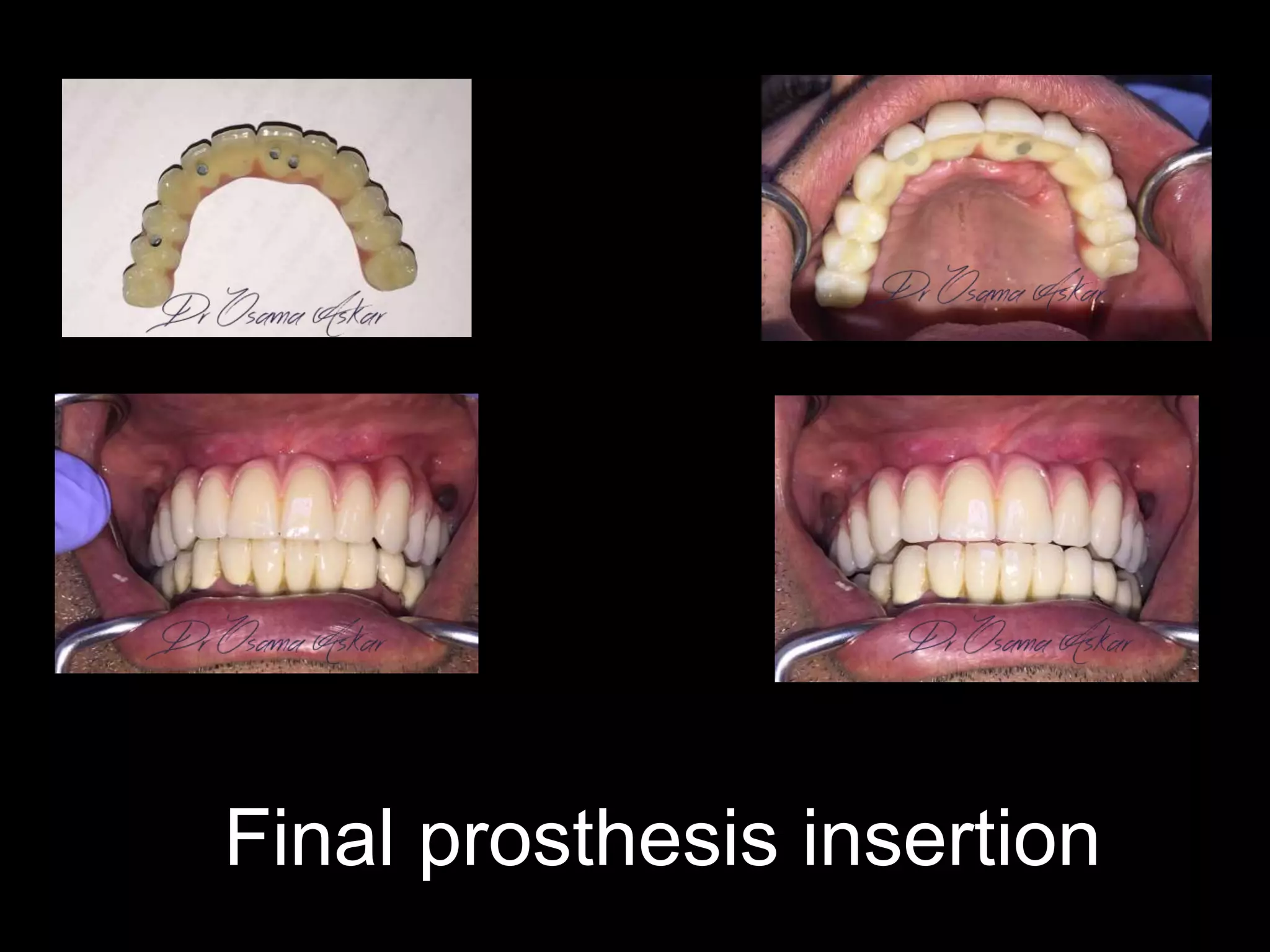 Peek implant supported screw retained maxillary complete overdenture | PPTX