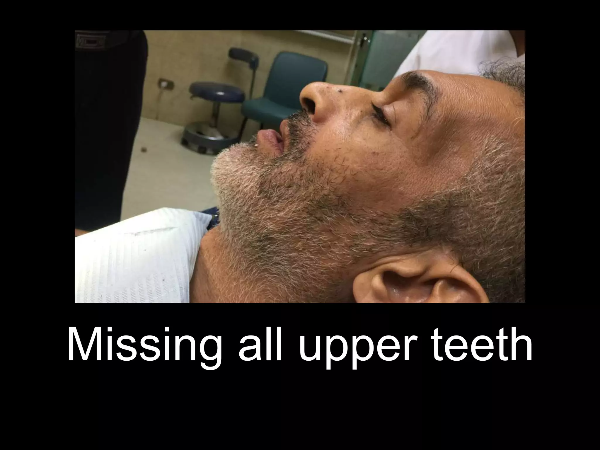 Peek implant supported screw retained maxillary complete overdenture | PPTX