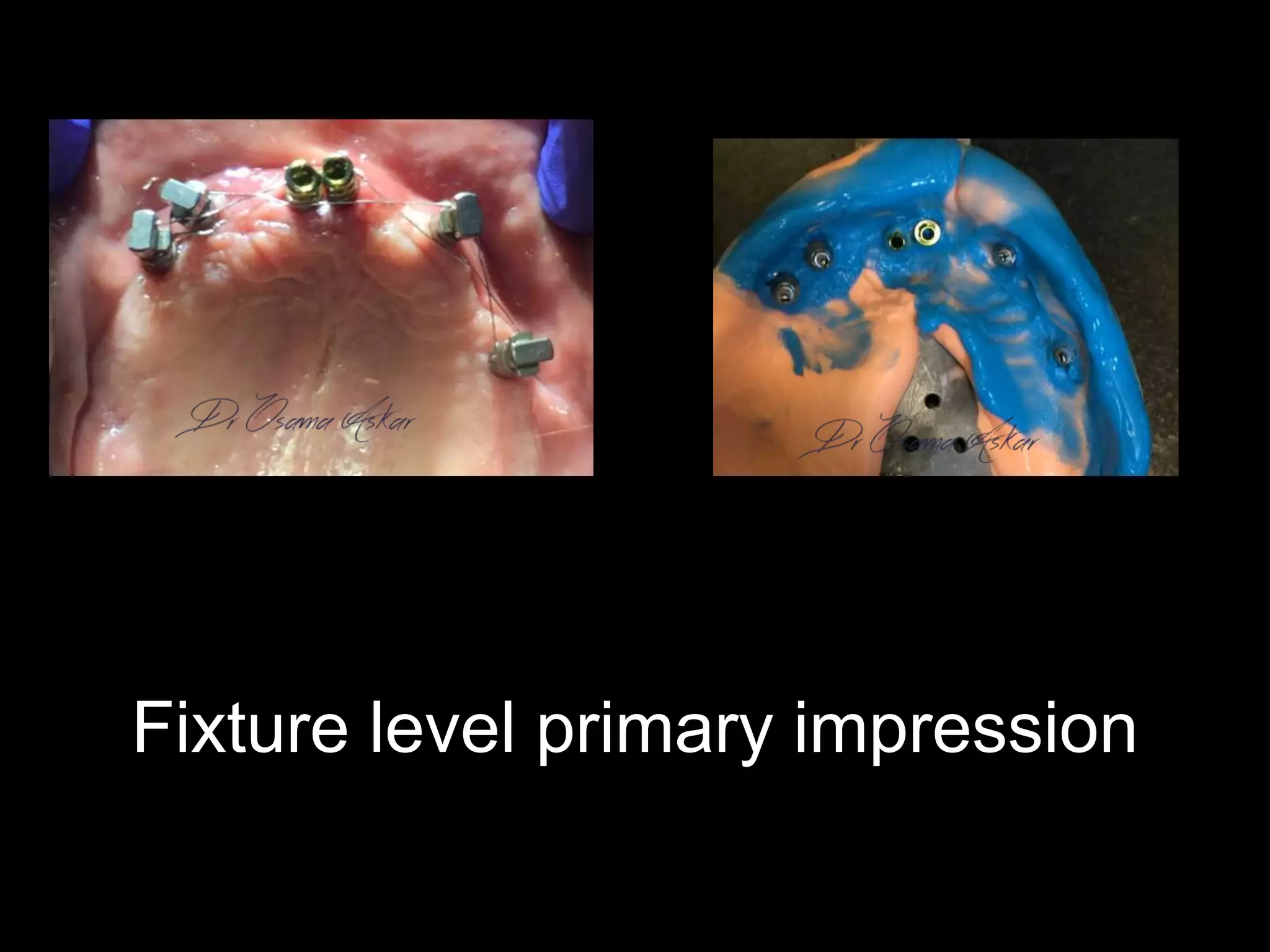 Peek implant supported screw retained maxillary complete overdenture | PPTX