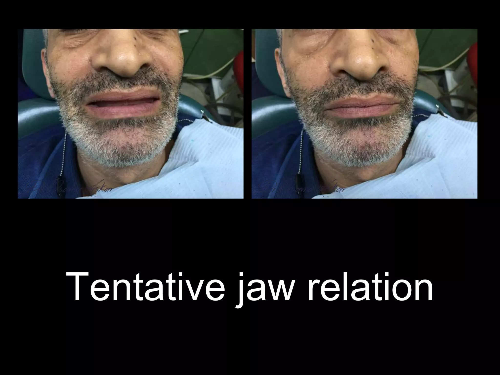 Peek implant supported screw retained maxillary complete overdenture | PPTX