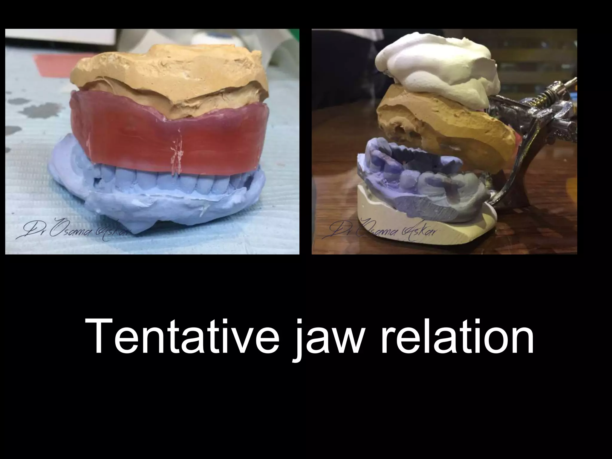 Peek implant supported screw retained maxillary complete overdenture | PPTX