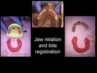 Peek implant supported screw retained maxillary complete overdenture | PPTX