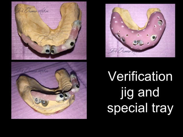 Peek implant supported screw retained maxillary complete overdenture | PPTX
