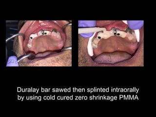 Peek implant supported screw retained maxillary complete overdenture | PPTX
