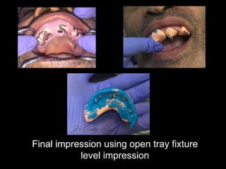 Peek implant supported screw retained maxillary complete overdenture | PPTX