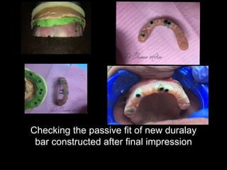 Peek implant supported screw retained maxillary complete overdenture | PPTX