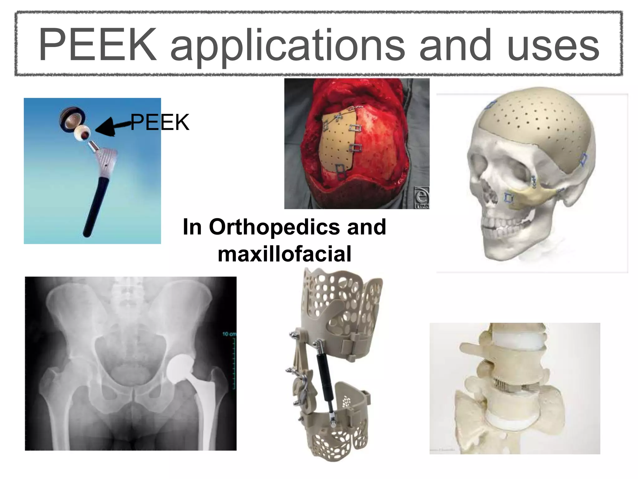 Peek material as an option in managing difficult implants positions and ...