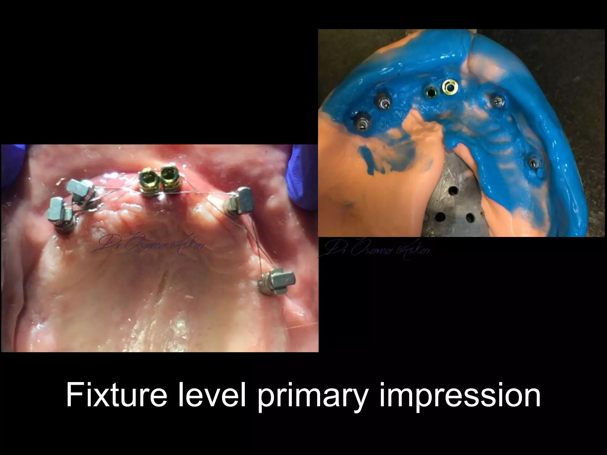 Peek material as an option in managing difficult implants positions and ...