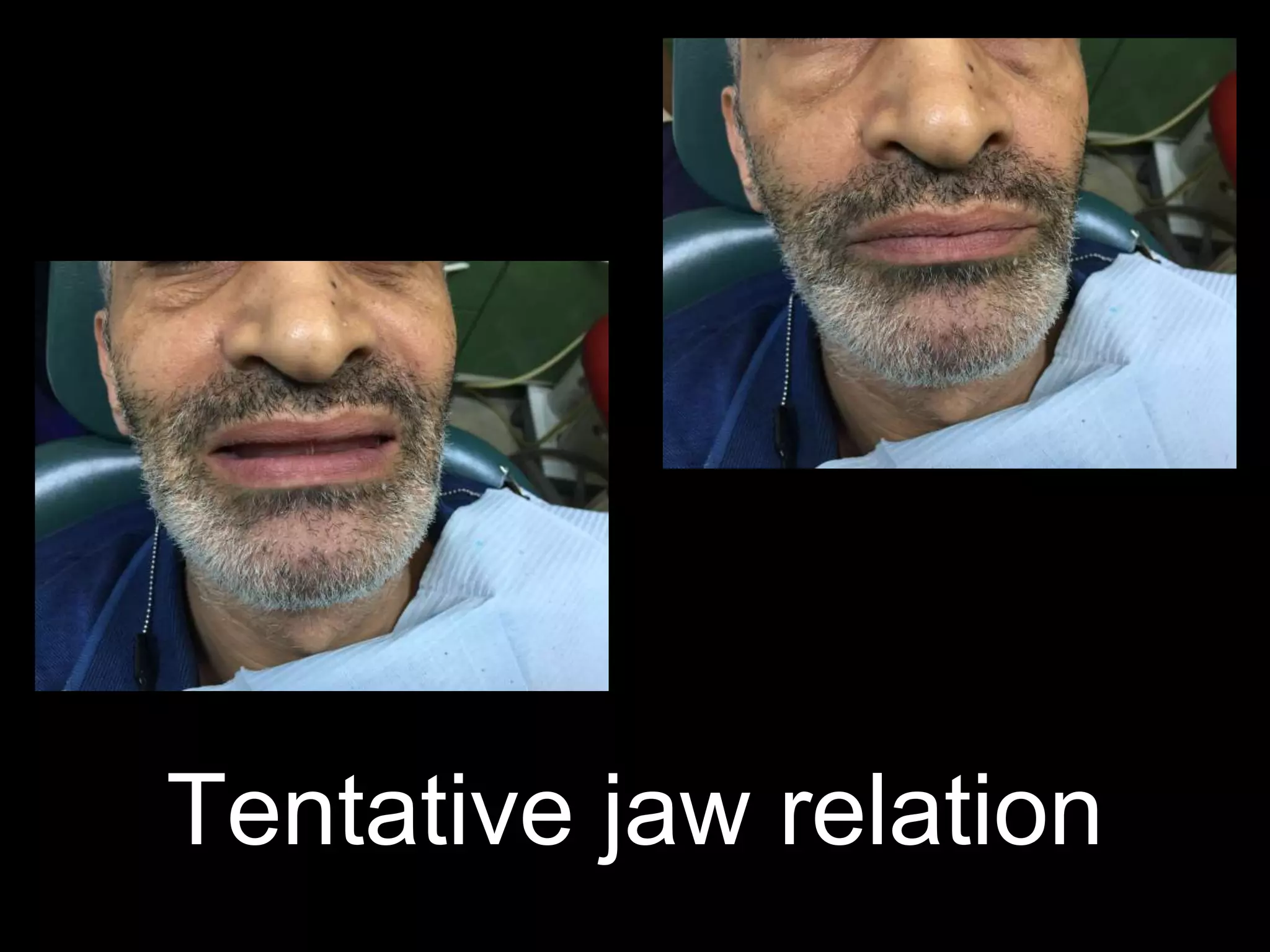 Peek material as an option in managing difficult implants positions and angulation (modified) | PPTX