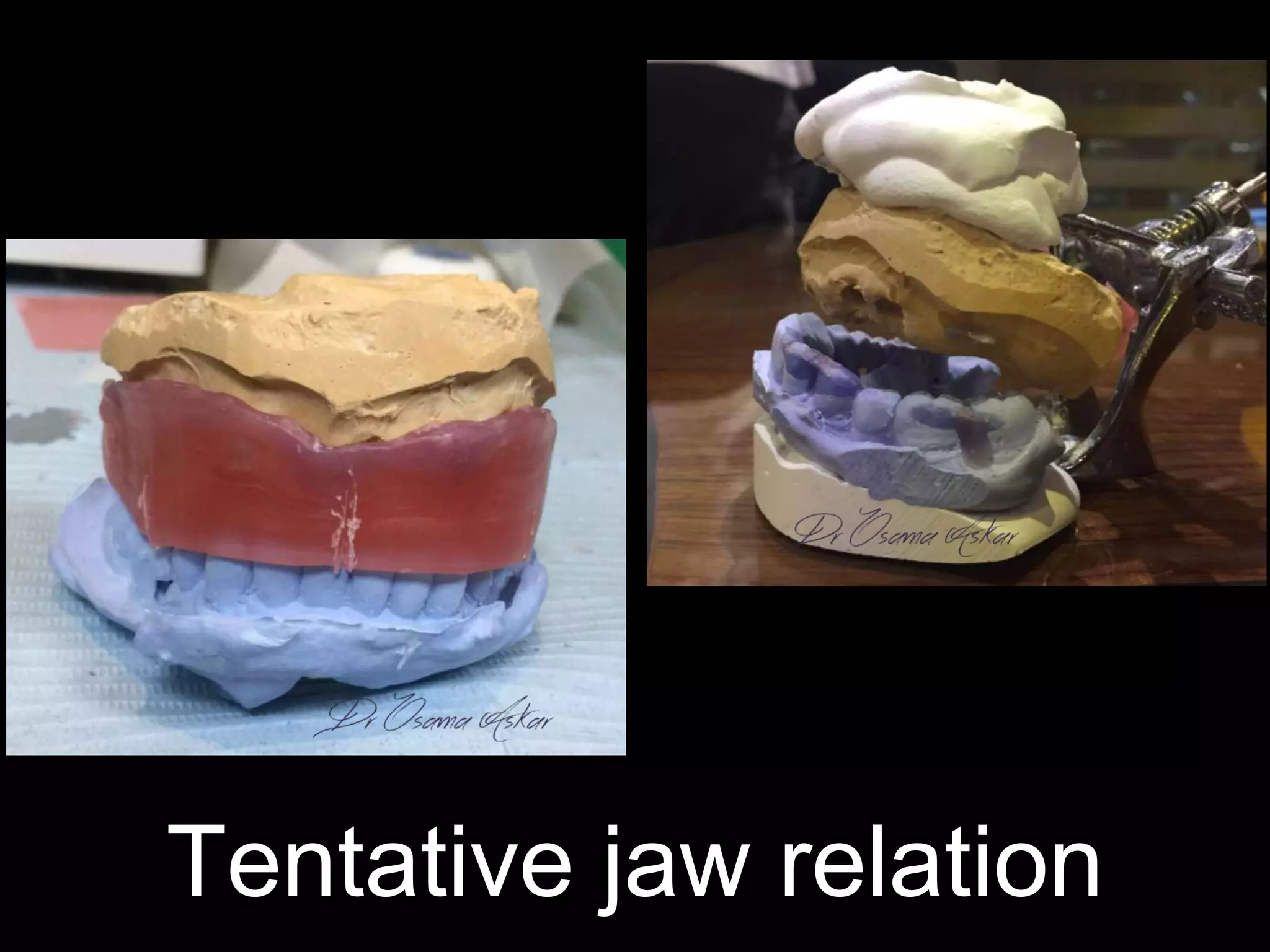 Peek material as an option in managing difficult implants positions and angulation (modified) | PPTX
