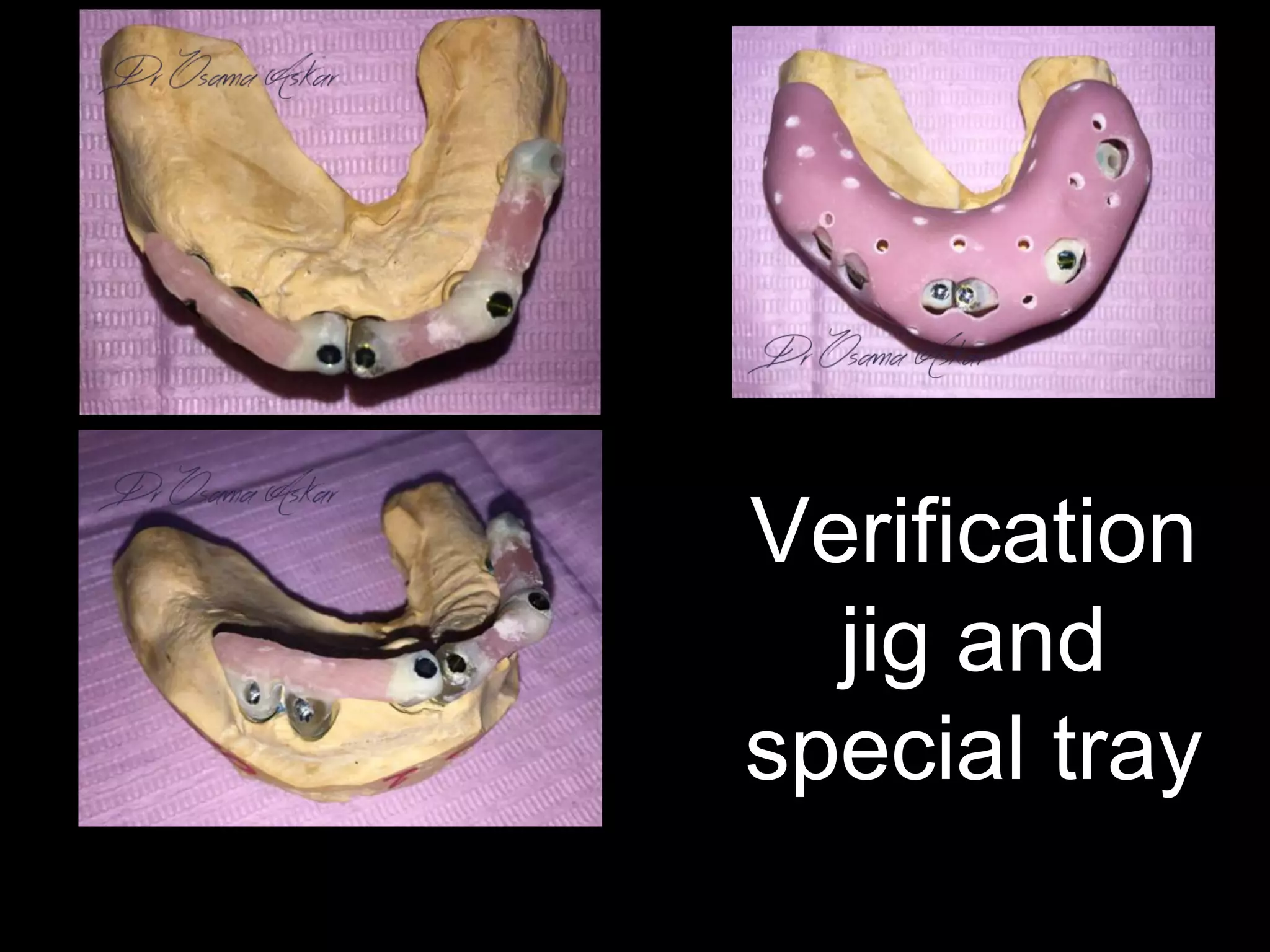 Peek material as an option in managing difficult implants positions and angulation (modified) | PPTX