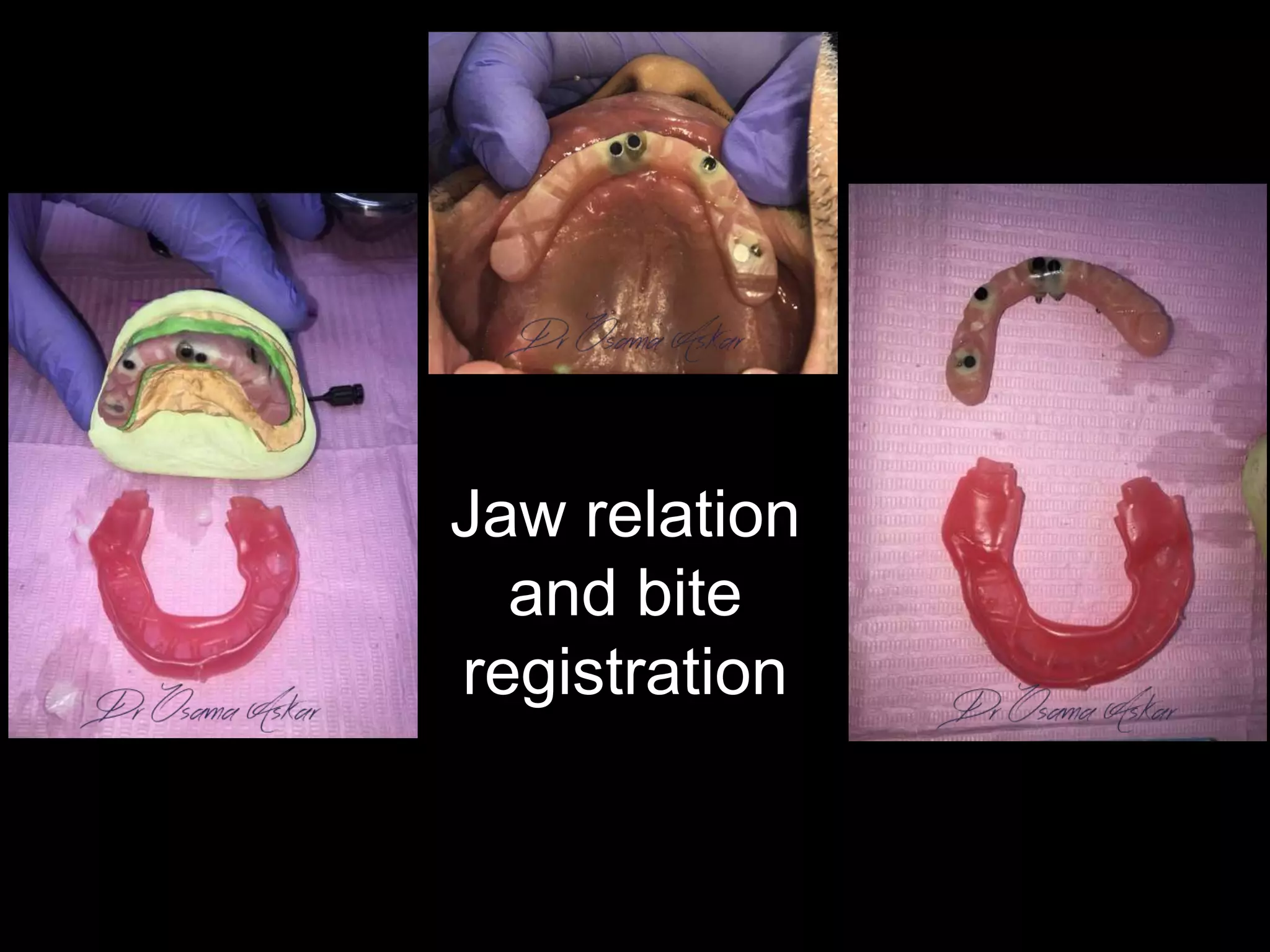 Peek material as an option in managing difficult implants positions and angulation (modified) | PPTX