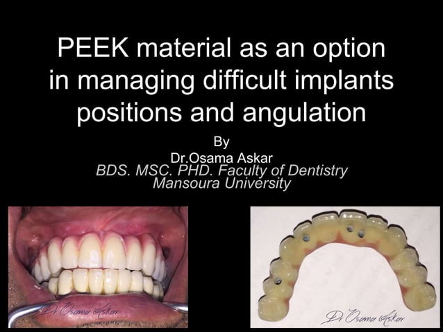 Peek material as an option in managing difficult implants positions and angulation (modified) | PPTX