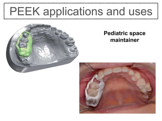 Peek material as an option in managing difficult implants positions and ...