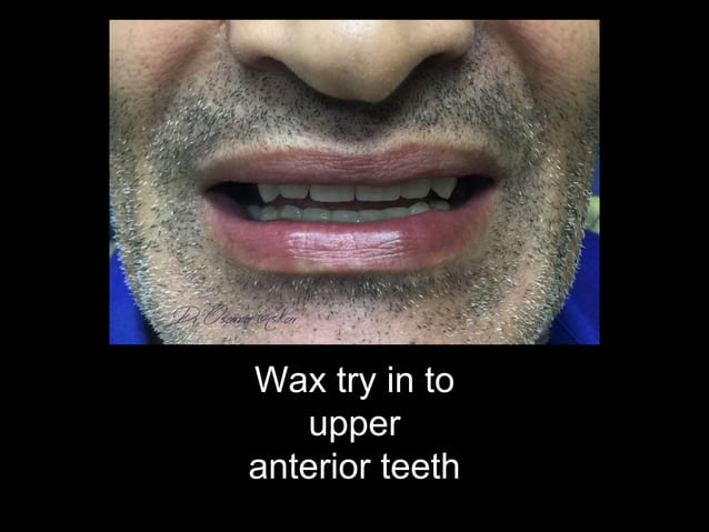 Peek material as an option in managing difficult implants positions and angulation (modified) | PPTX