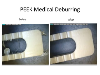 Peek medical deburring | PPTX | Medical Health
