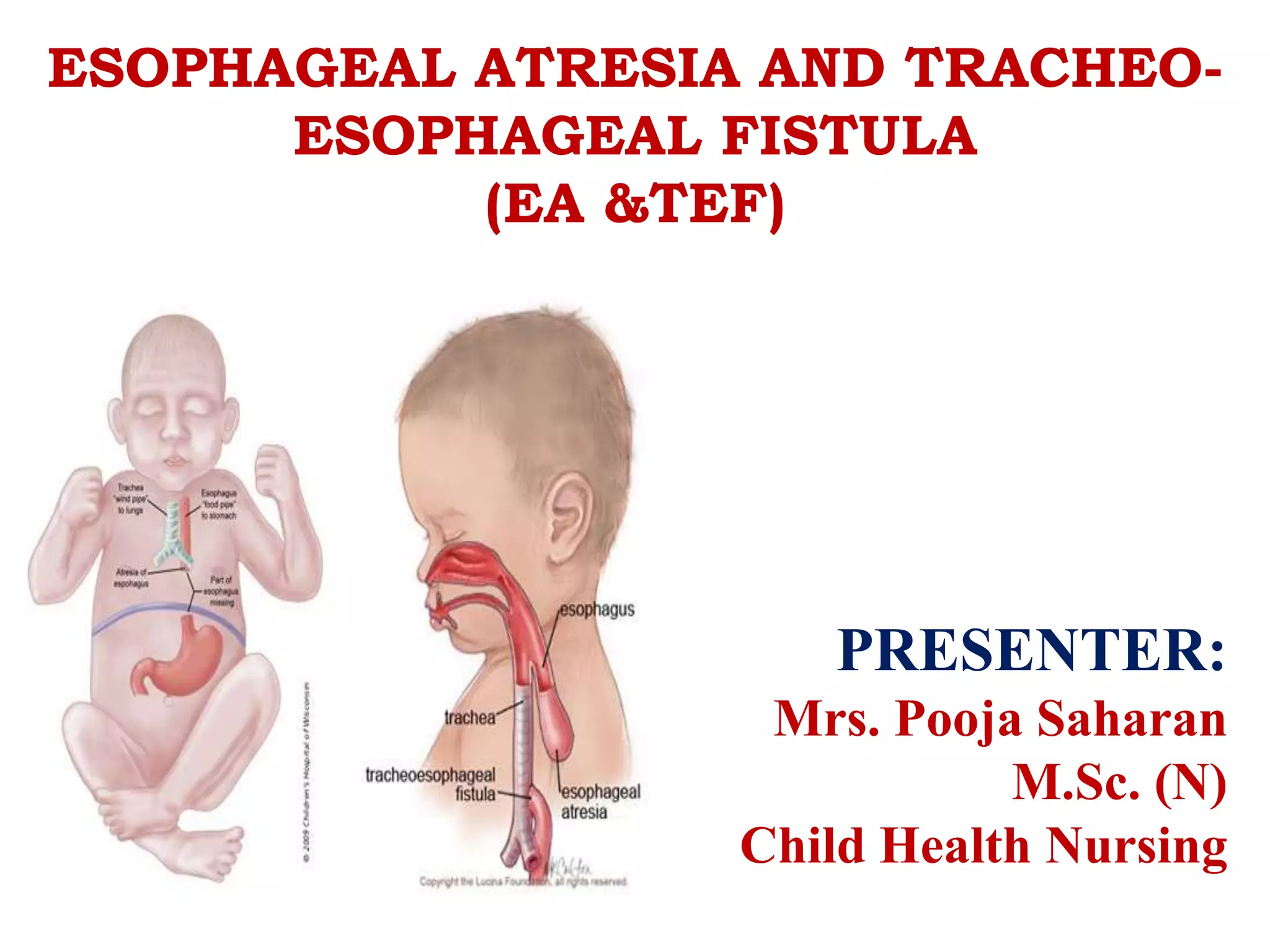 Esophageal Atresia (EA) and Tracheo Esophageal Fistula (TEF) | PPTX