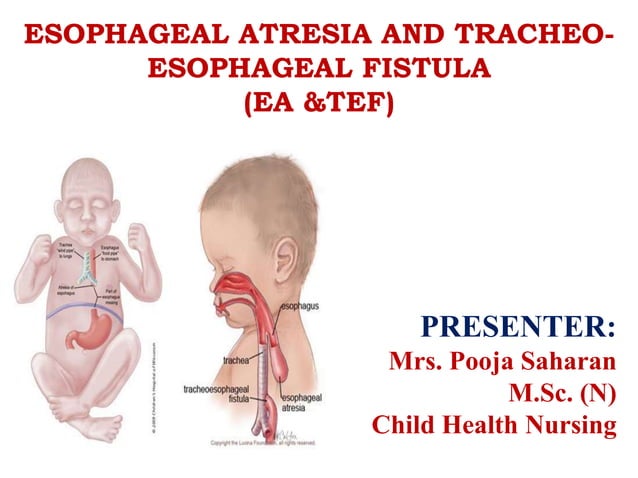Esophageal Atresia (EA) and Tracheo Esophageal Fistula (TEF) | PPTX