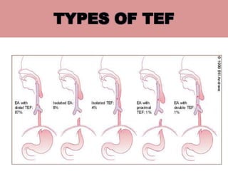 Esophageal Atresia (EA) and Tracheo Esophageal Fistula (TEF) | PPTX