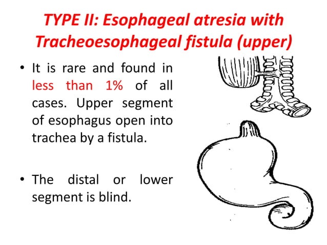 Esophageal Atresia (EA) and Tracheo Esophageal Fistula (TEF) | PPTX