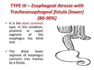 Esophageal Atresia (EA) and Tracheo Esophageal Fistula (TEF) | PPTX