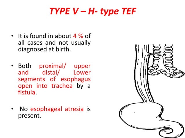 Esophageal Atresia (EA) and Tracheo Esophageal Fistula (TEF) | PPTX