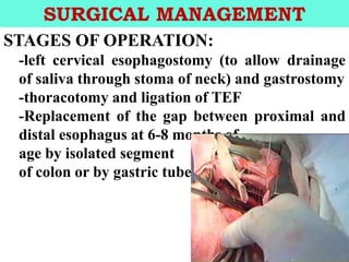 Esophageal Atresia (EA) and Tracheo Esophageal Fistula (TEF) | PPT