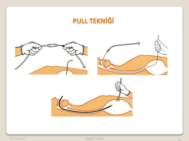 Perkütan Endoskopik Gastrostomi | PPTX