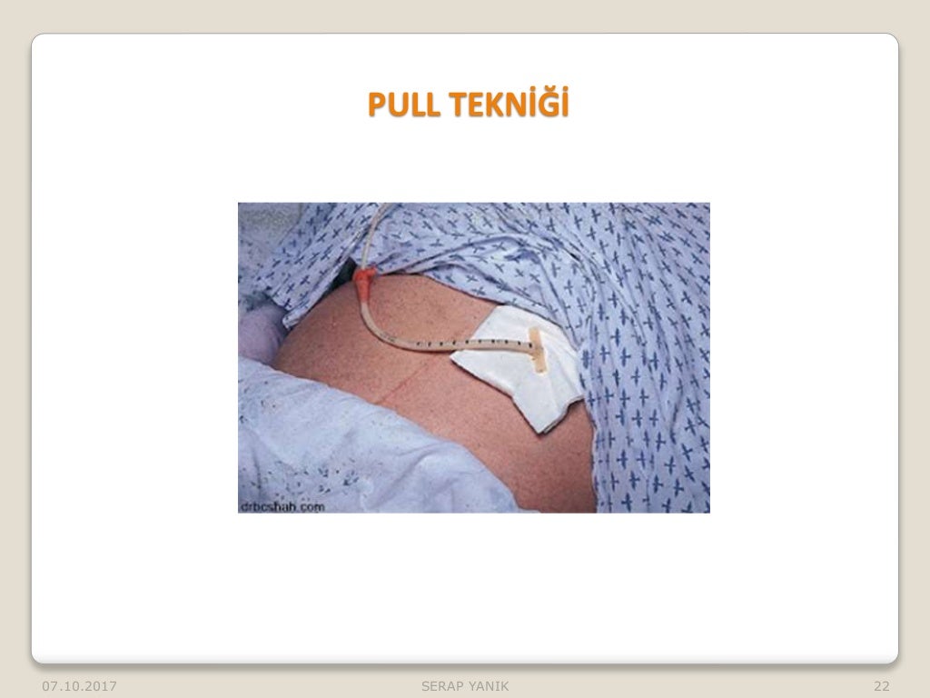 Perkütan Endoskopik Gastrostomi