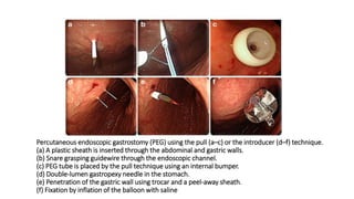 Percutaneous Endoscopic Gastrostomy: Complications & Risk Factors.pptx