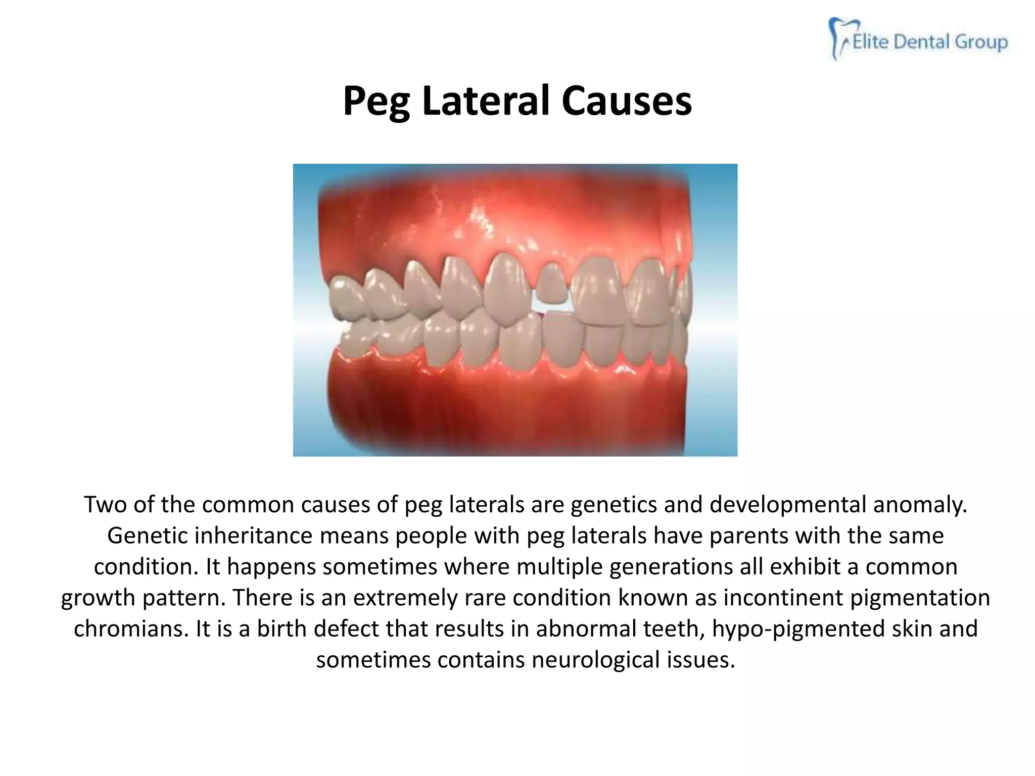 PEGGED TEETH- MEANING, CAUSES AND TREATMENT | PPTX