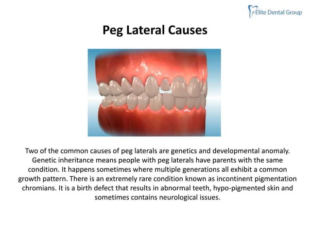 PEGGED TEETH- MEANING, CAUSES AND TREATMENT | PPTX | Dental Health ...