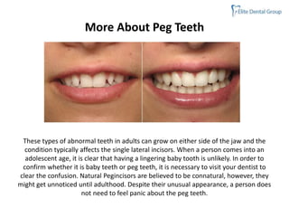 PEGGED TEETH- MEANING, CAUSES AND TREATMENT | PPTX