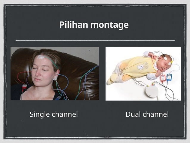 Pelatihan BERA ASSR Natus [Autosaved].pptx