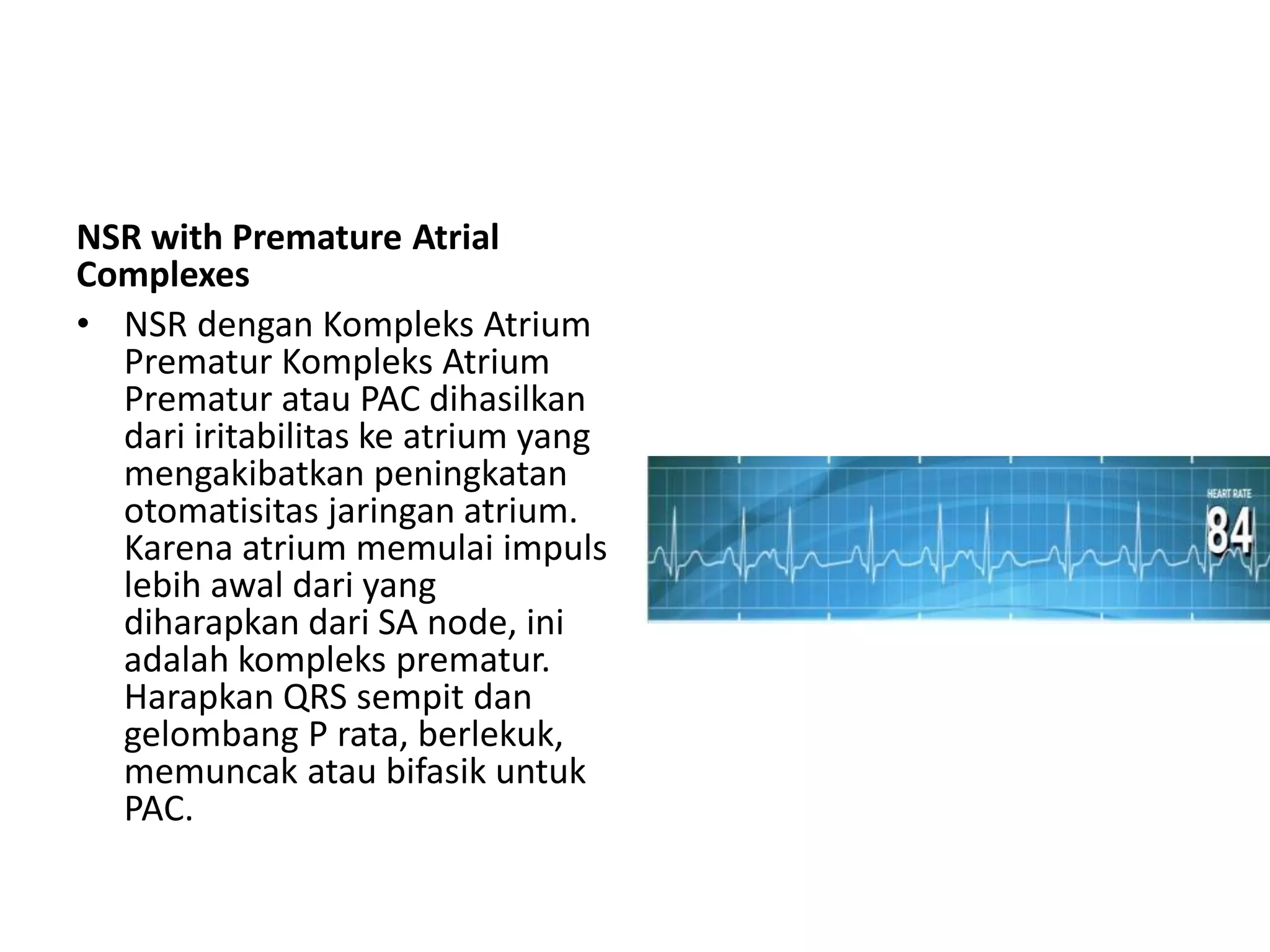 PELATIHAN EKG ARITMIA.pptx