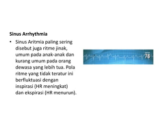 PELATIHAN EKG ARITMIA.pptx