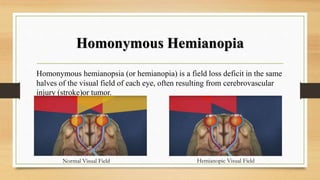 Peli’s Field Expansion Prisms.pptx