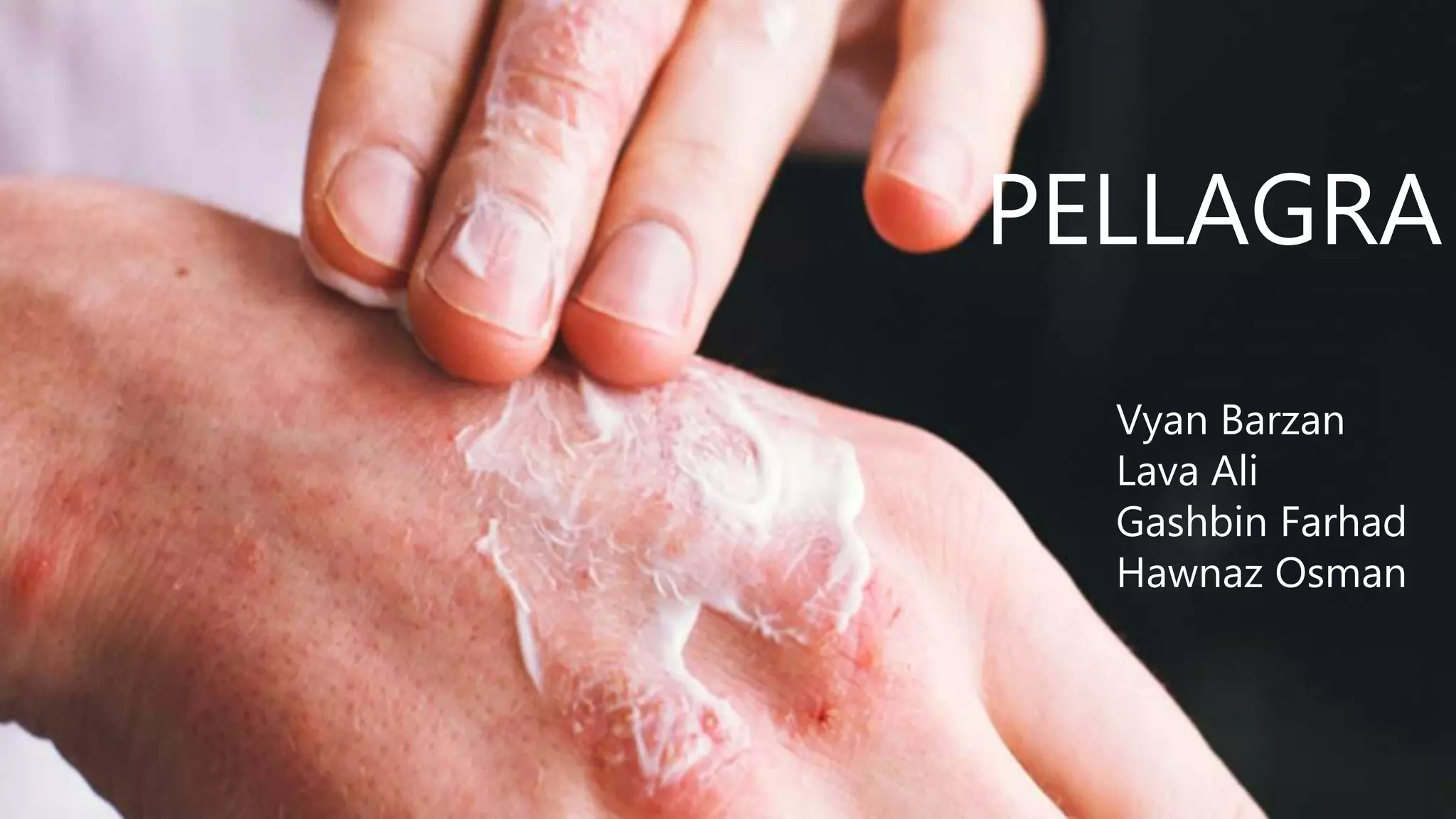 Pellagra | PPTX