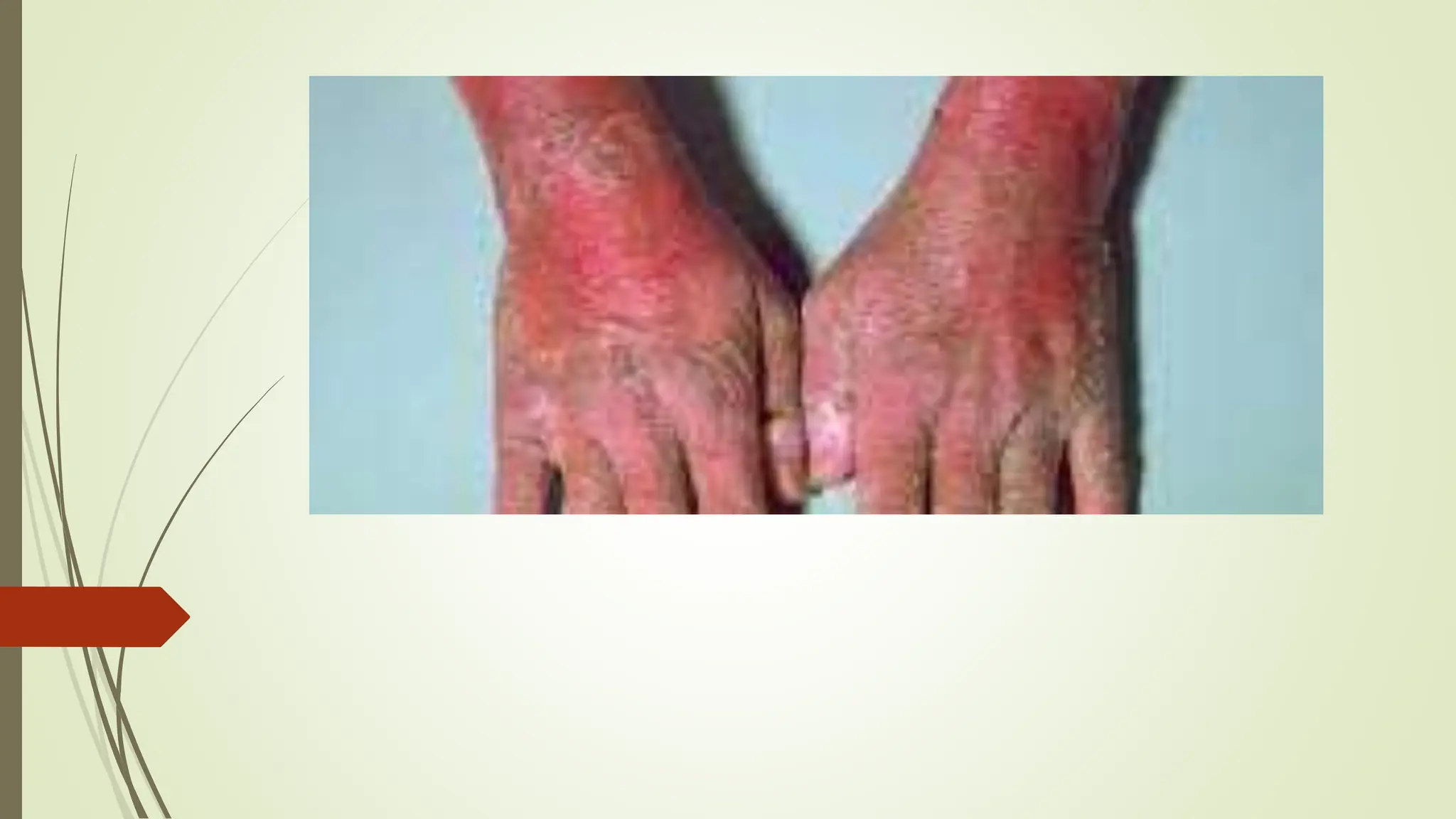 Pellagra vitamin deficiency and treatment.pptx