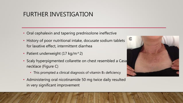 Pellagra Biochemistry Case Study | PPT