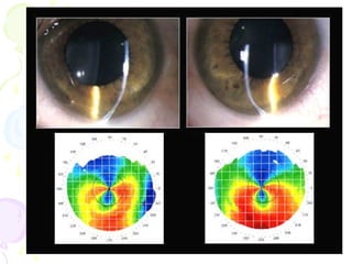 Pellucid Marginal Degeneration