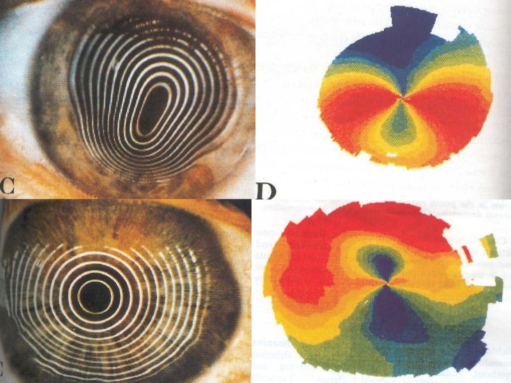 Pellucid marginal degeneration