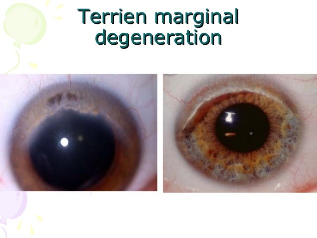 Pellucid marginal degeneration