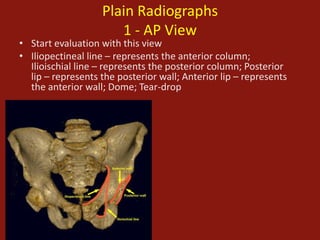 Pelvic and acetabular fractures | PPTX