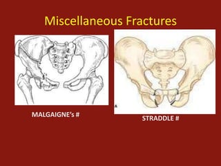 Straddle Fracture