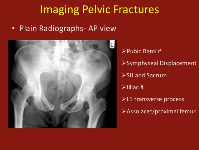 Pelvic and acetabular fractures