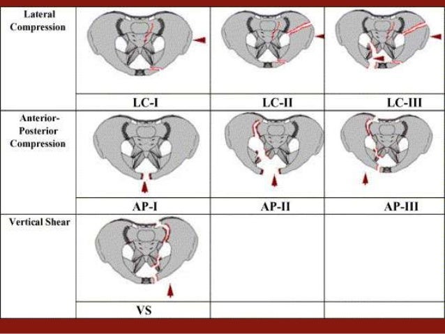 Pelvic and acetabular fractures